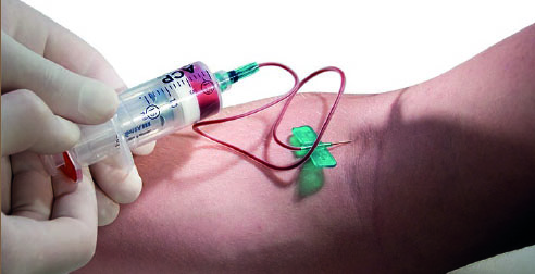 ACP® Double Syringe : GYNEMED GmbH & Co. KG