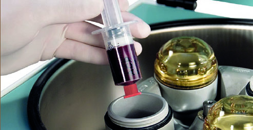 ACP® Double Syringe : GYNEMED GmbH & Co. KG